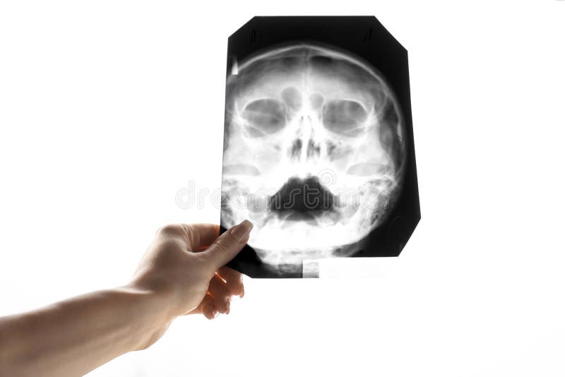 X-ray of the Head. Fluorography of Maxillary Sinuses Stock Photo ...