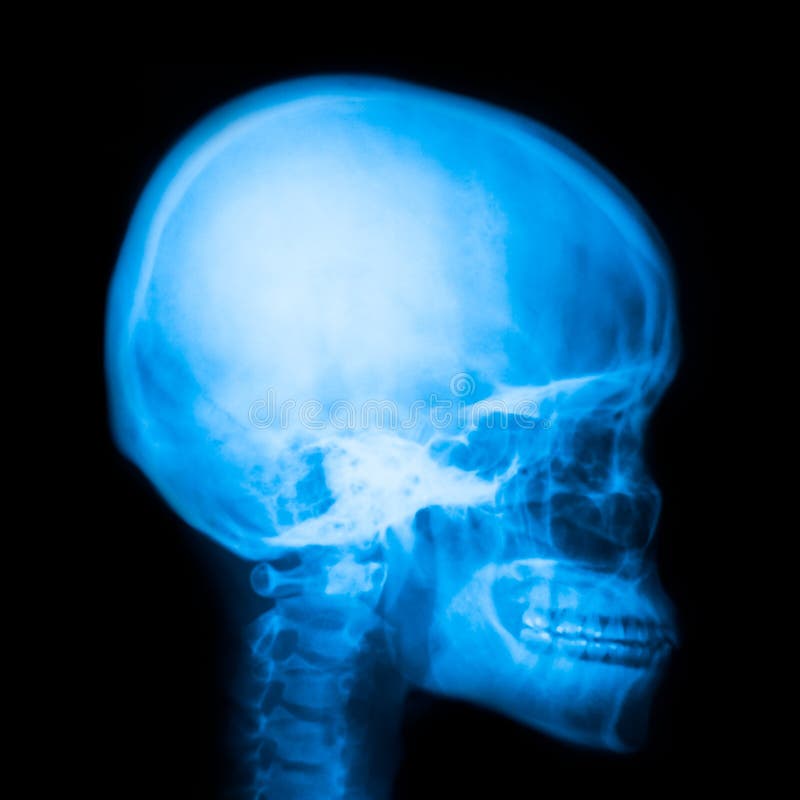 X Ray Head Neck Stock Photos - Download 811 Royalty Free Photos