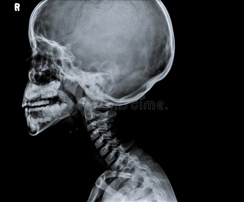 X Ray of Head Showing Part of Neck. Stock Photo - Image of neck, trauma ...