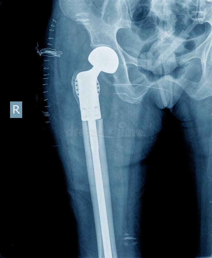 X-ray of hip prosthesis stock photo. Image of pelvis - 47702872