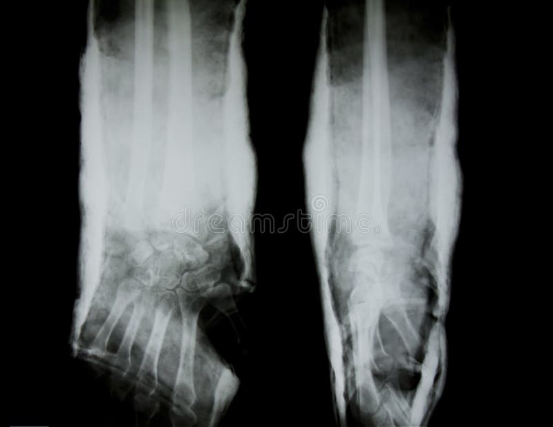 X-ray of human arm stock photo. Image of doctor, healthcare - 53764406