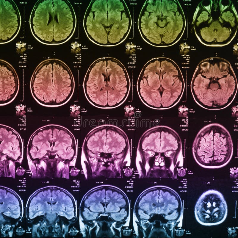 The X-ray of the Human Brain Stock Photo - Image of xray, radiology ...