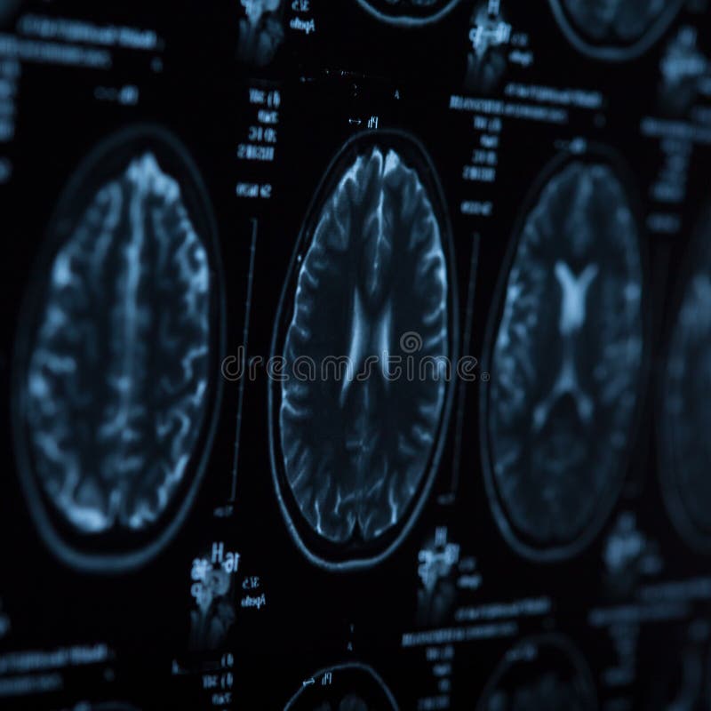 The X-ray of the Human Brain Stock Photo - Image of medical, human ...