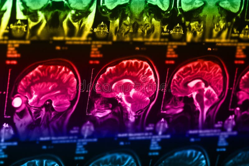 The X-ray of the Human Brain Stock Image - Image of neurology, scan ...