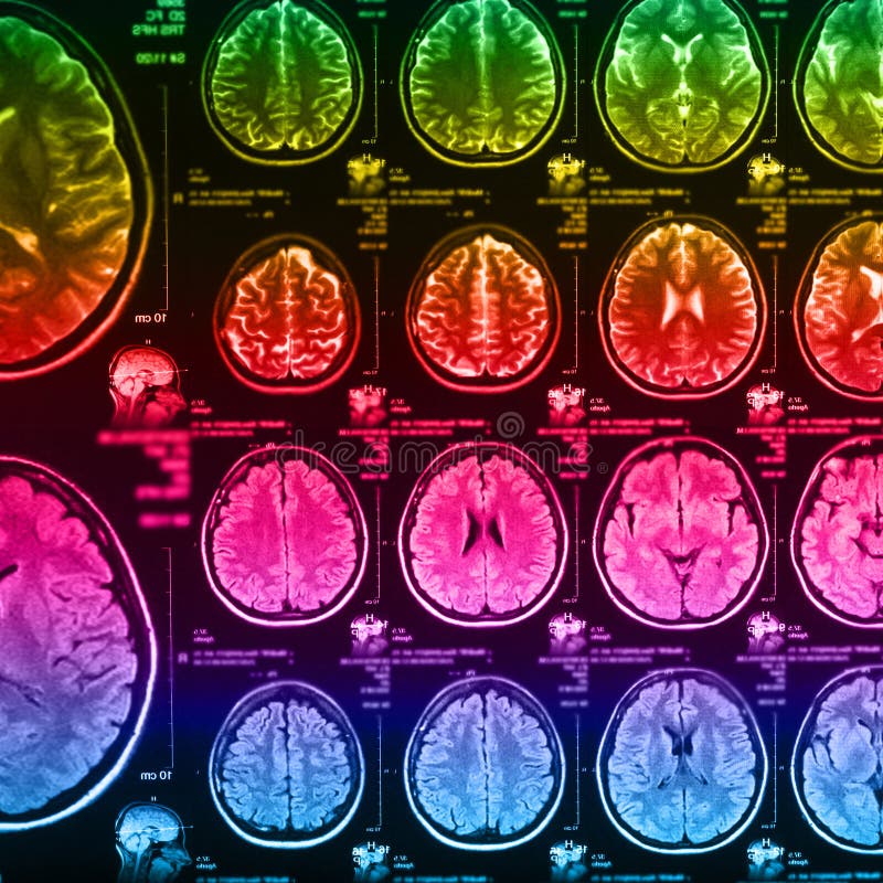 The X-ray of the Human Brain Stock Photo - Image of resonance, test ...