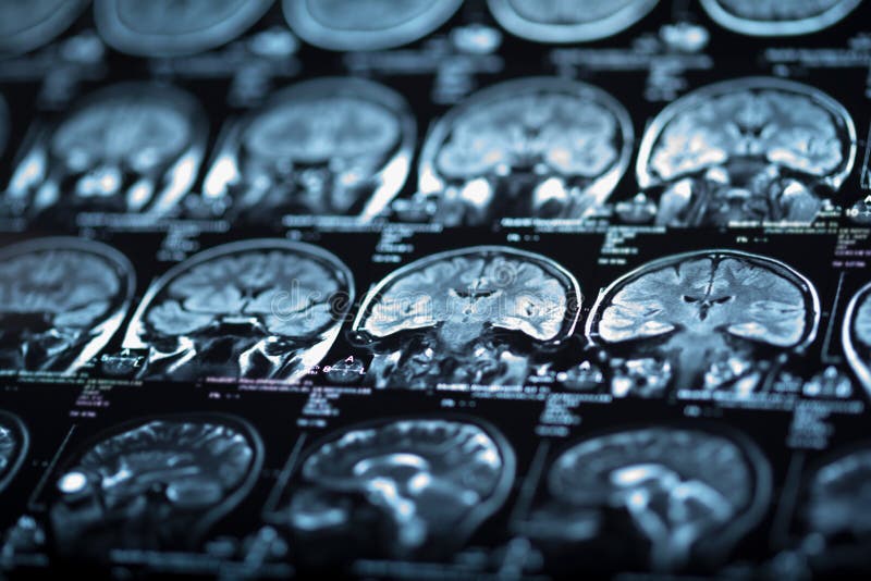 The X-ray Of The Human Brain Stock Image - Image of xray, head: 124999145