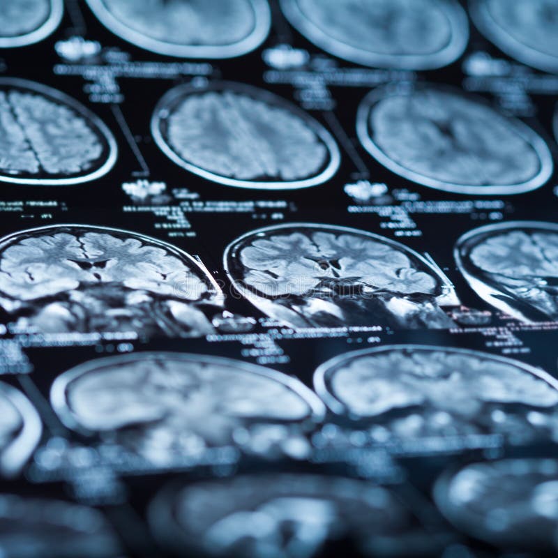 The X-ray of the Human Brain Stock Photo - Image of scan, disease ...