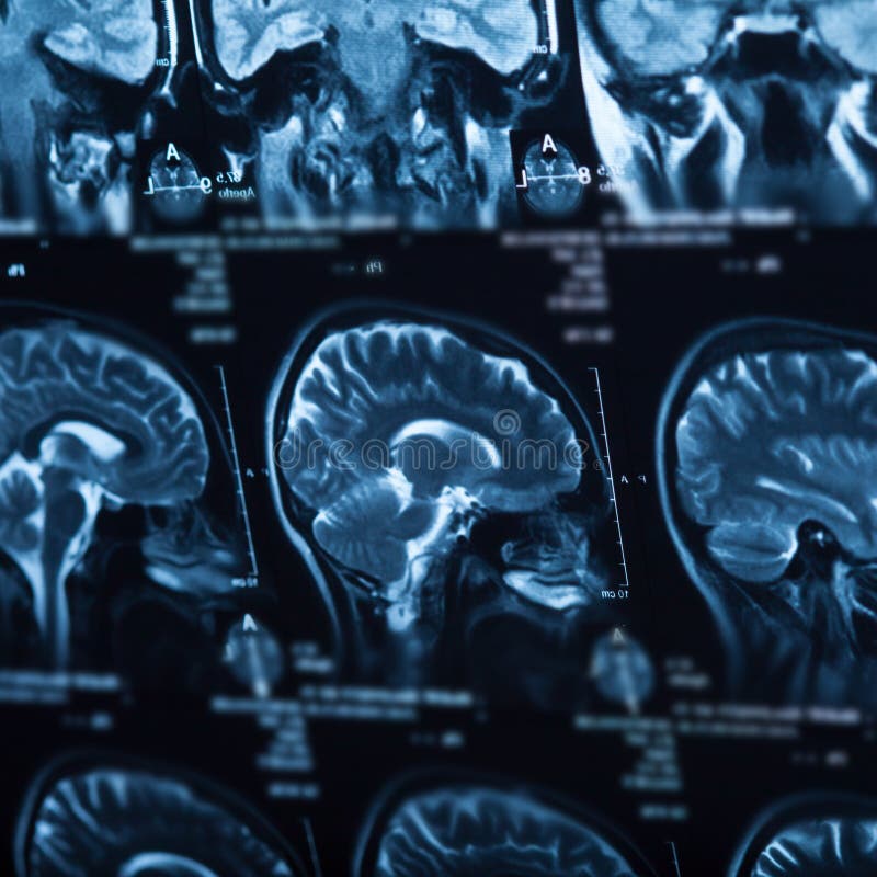 The X-ray of the Human Brain Stock Image - Image of treatment, human ...