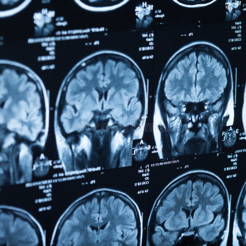 The X-ray of the Human Brain Stock Image - Image of imaging, xray ...