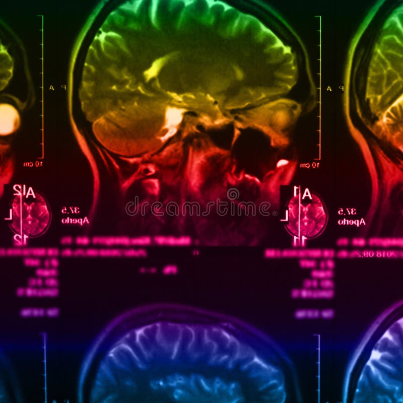 The X-ray Of The Human Brain Stock Photo - Image of hospital, imaging ...