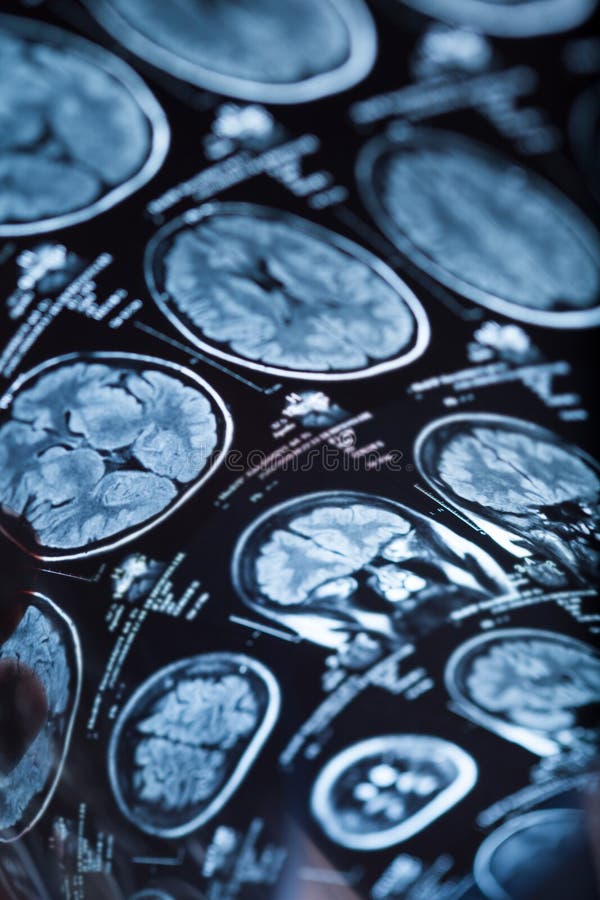 The X-ray of the Human Brain Stock Image - Image of health, healthcare ...