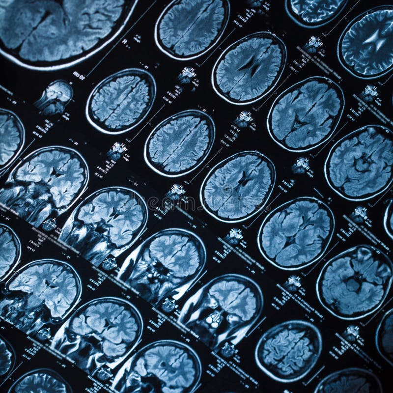 The X-ray of the Human Brain Stock Photo - Image of human, tumor: 124999512