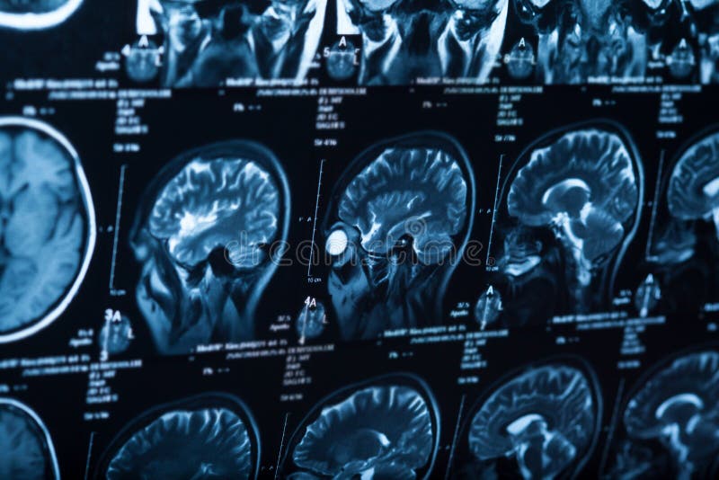 The X-ray of the Human Brain Stock Image - Image of magnetic, cancer ...