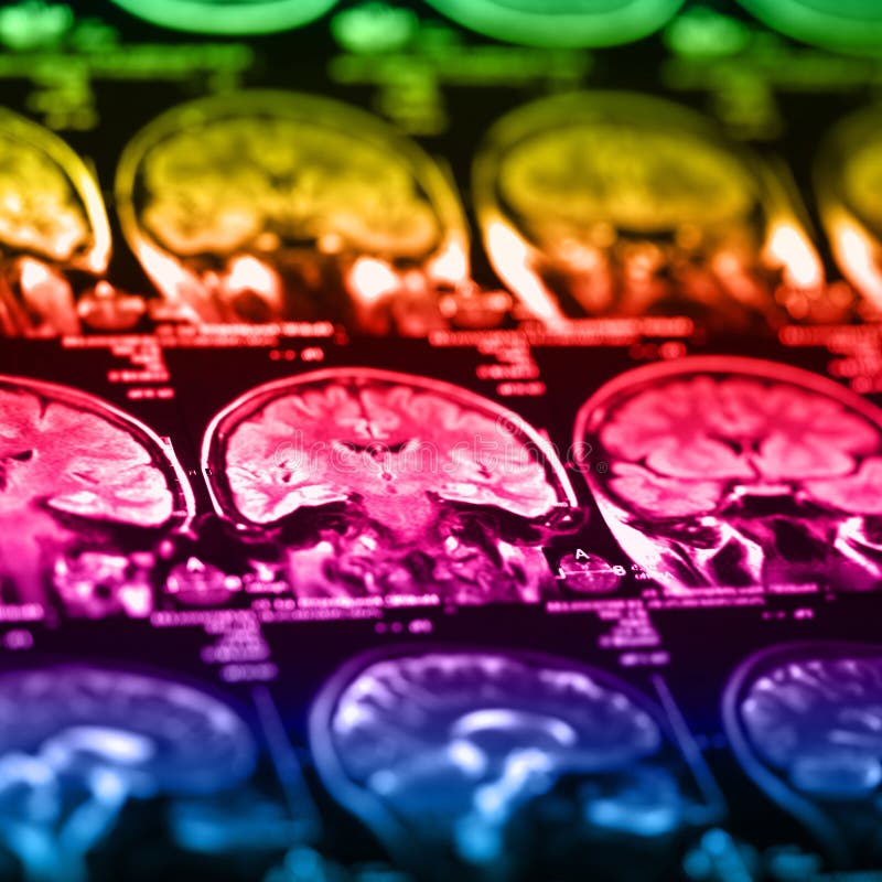 The X-ray of the Human Brain Stock Image - Image of human, imaging ...