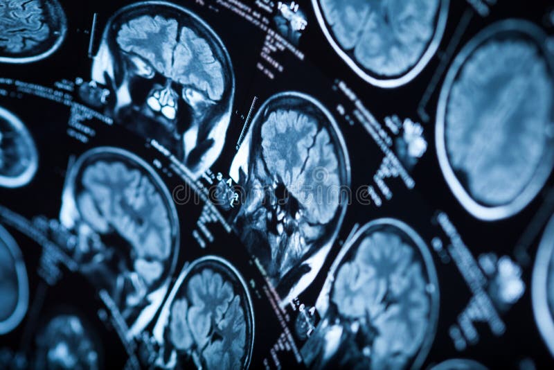 The X-ray of the Human Brain Stock Photo - Image of scan, medical ...