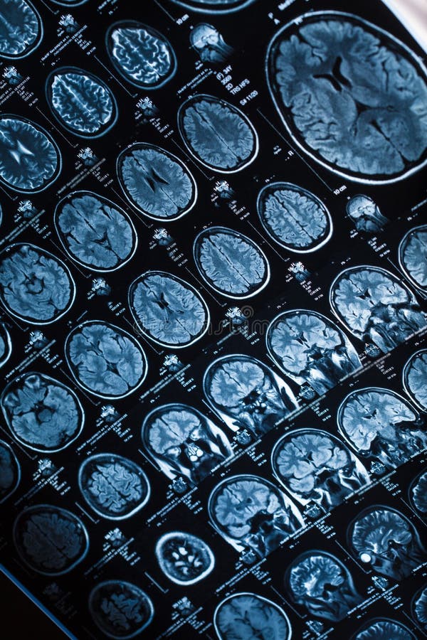 The X-ray of the Human Brain Stock Image - Image of magnetic, radiology ...