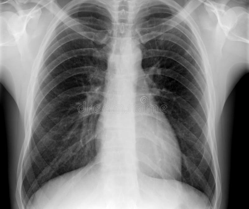 X-ray of human chest stock image. Image of lungs, human - 23597903