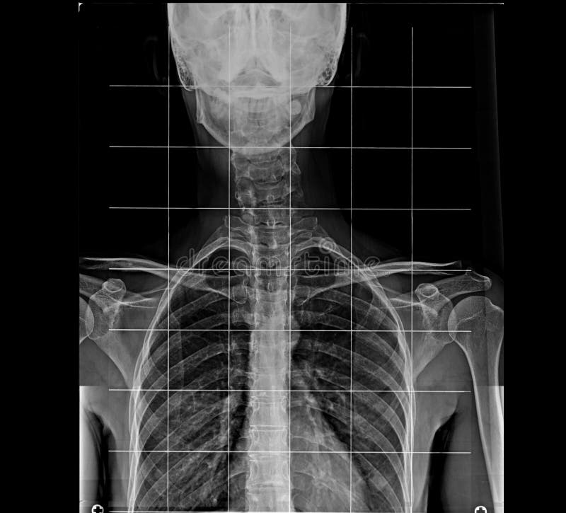 X-ray of Human Chest and Spinal Column, Front View Stock Photo - Image ...