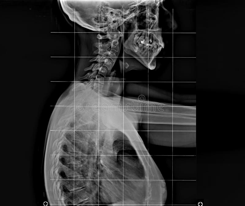 X-ray of Human Body, from Chest To Pelvis, Complete Spinal, Kyphosis ...