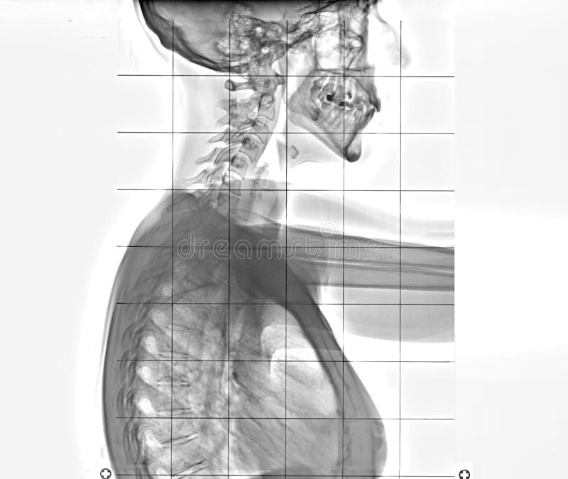 X-ray of Human Chest and Spinal Column, Side View Stock Image - Image ...