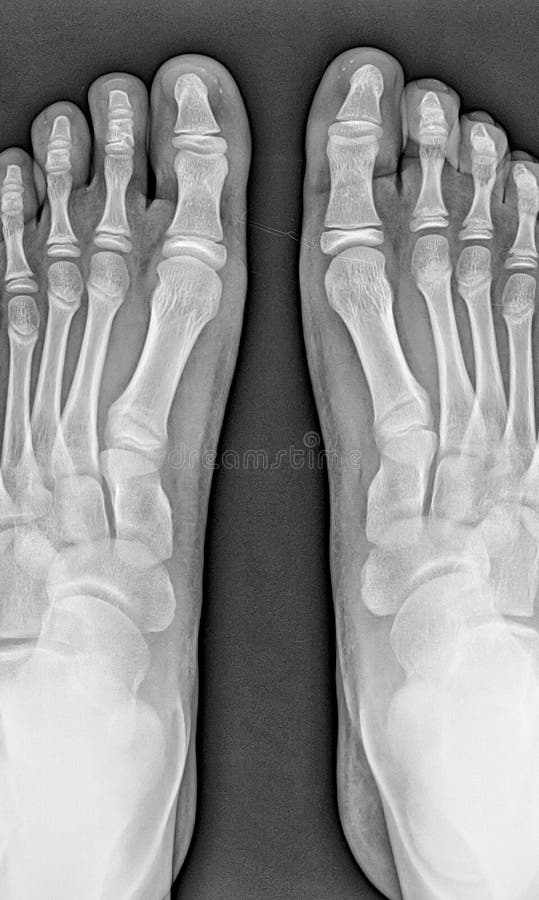 X-ray of Human Feet. Top View Stock Image - Image of ankle, radiology ...