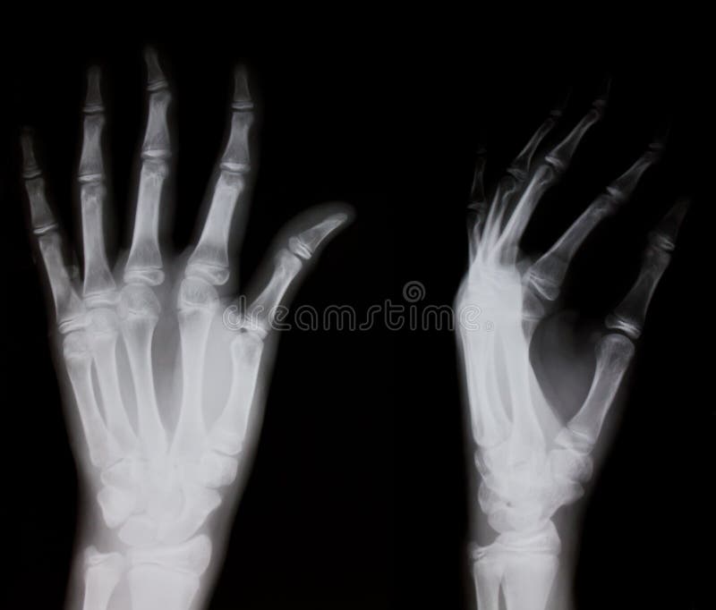 X-ray of human hand stock image. Image of fingertip, clinic - 15762073