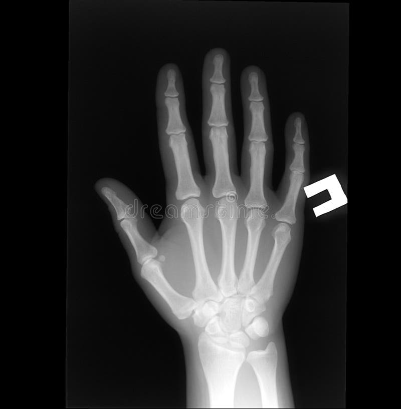 X-ray of hand stock photo. Image of black, medical, close - 47702784