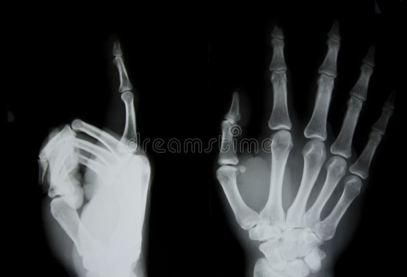 X-ray of human hand stock photo. Image of fingertip, care - 53764574