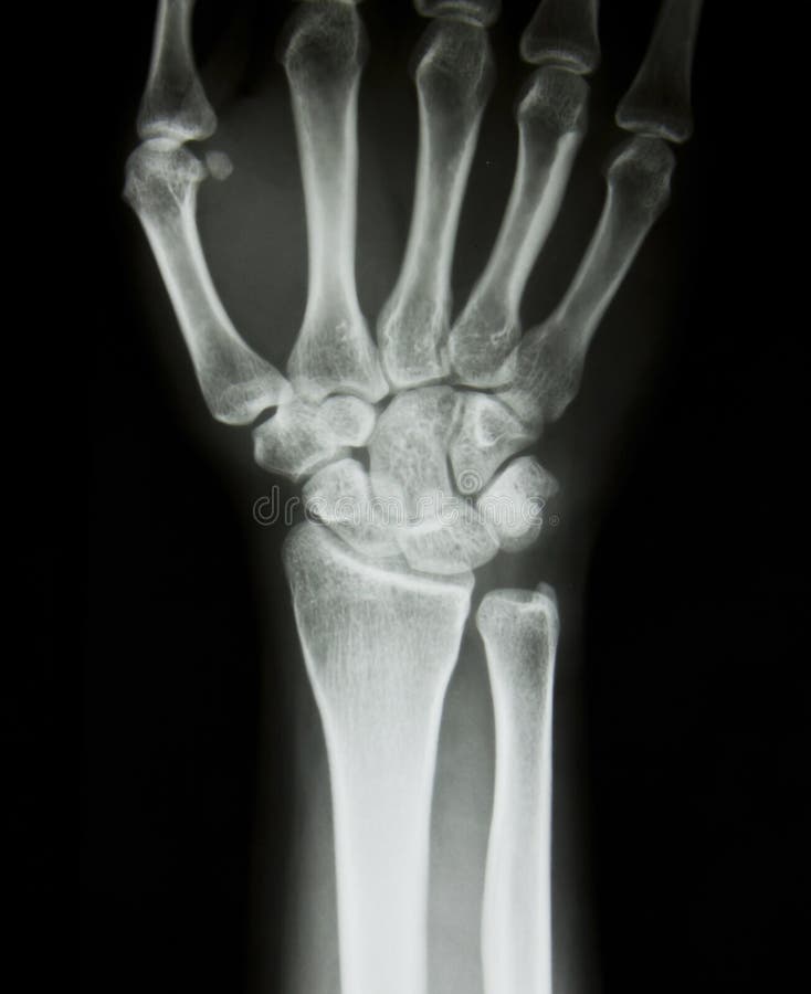 X-ray of human hand (OK!) stock photo. Image of skeleton - 15761862