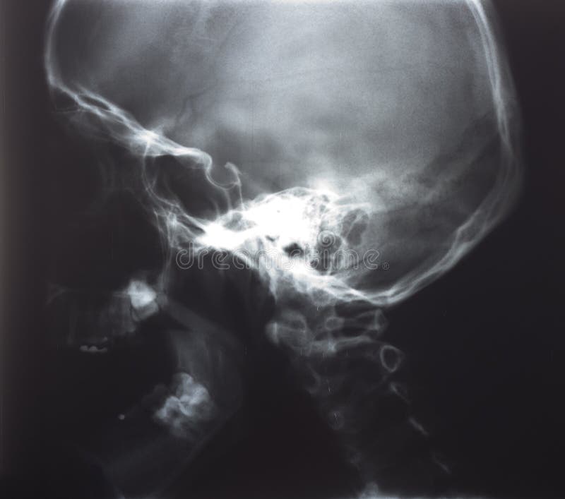 X-ray, Human Head stock photo. Image of physical, side - 46183608