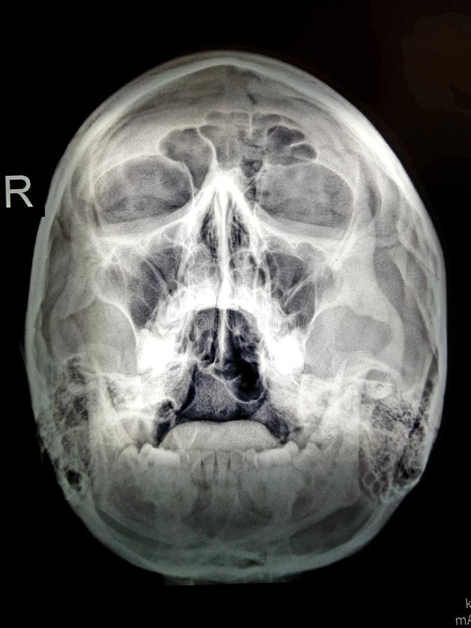 X-ray of a human head stock photo. Image of head, spine - 247025512