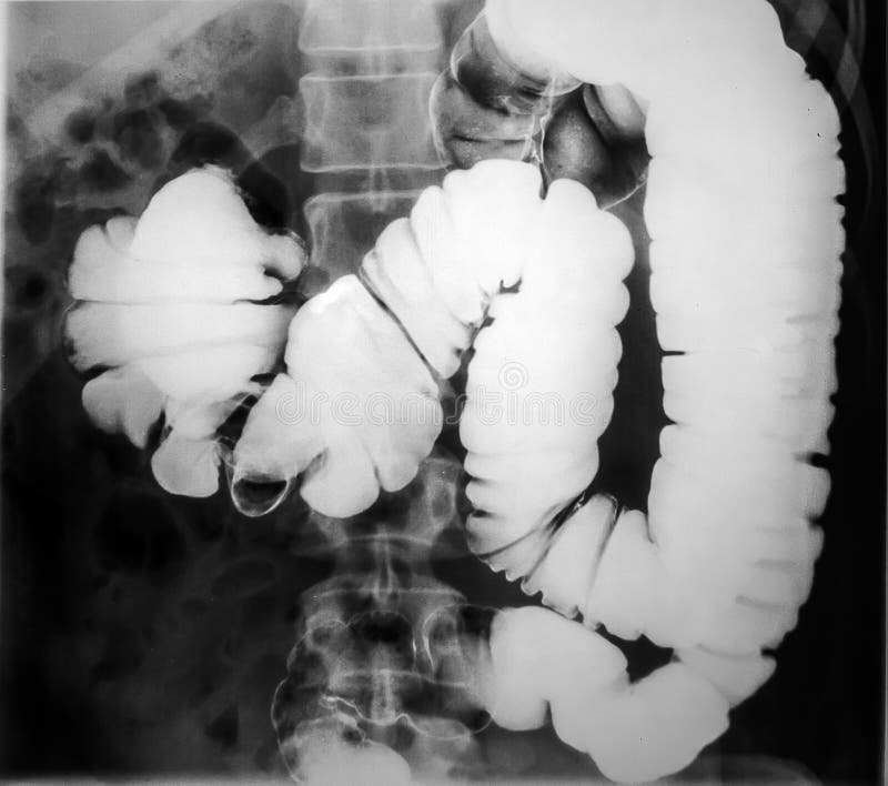 X-ray of the Human Intestine Stock Image - Image of hospital, equipment ...