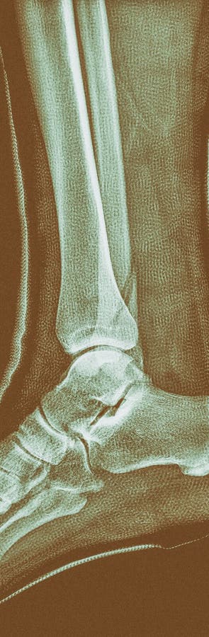 X-ray of Human Left Foot. Lateral View Stock Photo - Image of injury ...