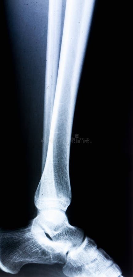 Rtg Broken Leg Stock Photos - Free & Royalty-Free Stock Photos from ...