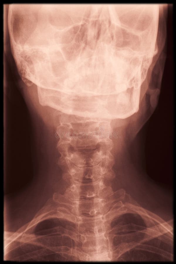X-ray of a Human Neck and Skull Stock Image - Image of medical, balack ...