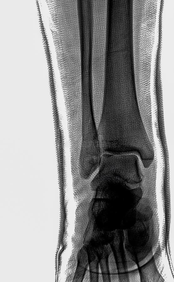 X-ray of Human Right Foot. View from Top Stock Photo - Image of illness ...