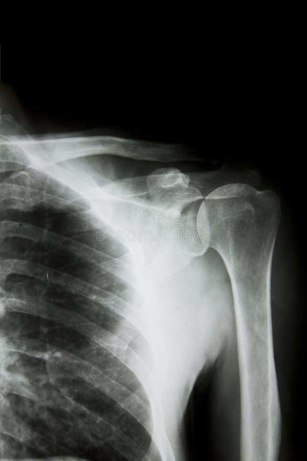 X-ray of Human Shoulder (broken Shoulder) Stock Photo - Image of ...