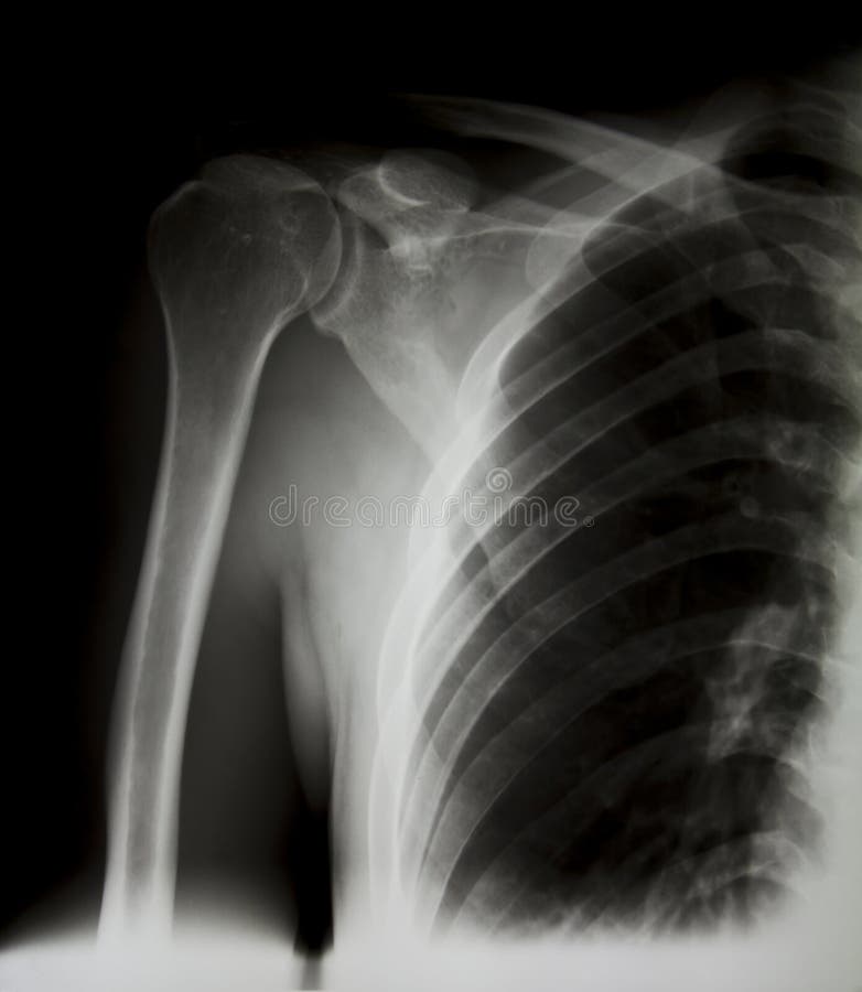 X-ray of human shoulder. stock image. Image of radiography - 53764395
