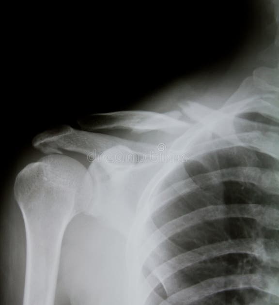 X-ray of Human Shoulder (broken Shoulder) Stock Photo - Image of ...