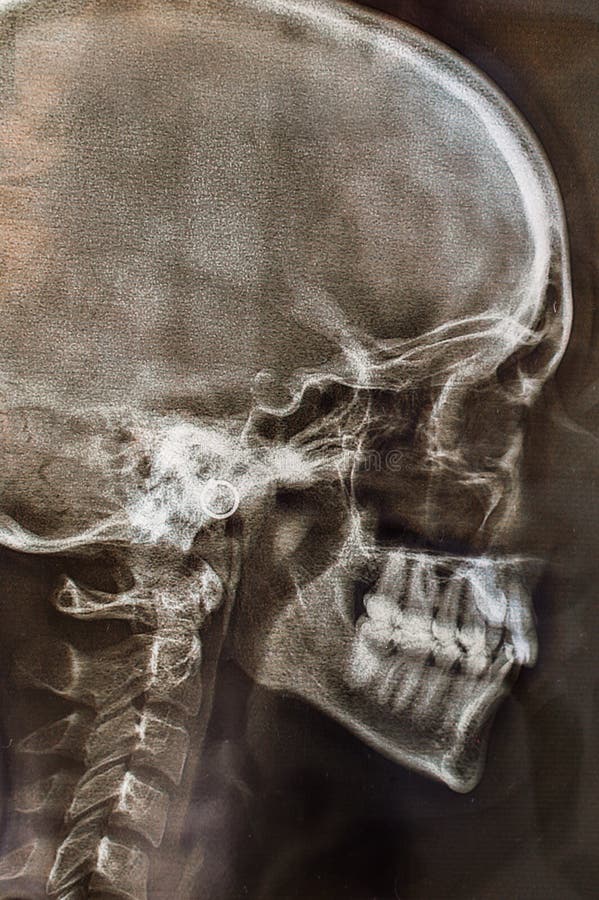 X-ray of the Human Skull in Lateral Projection Close-up Stock Image ...
