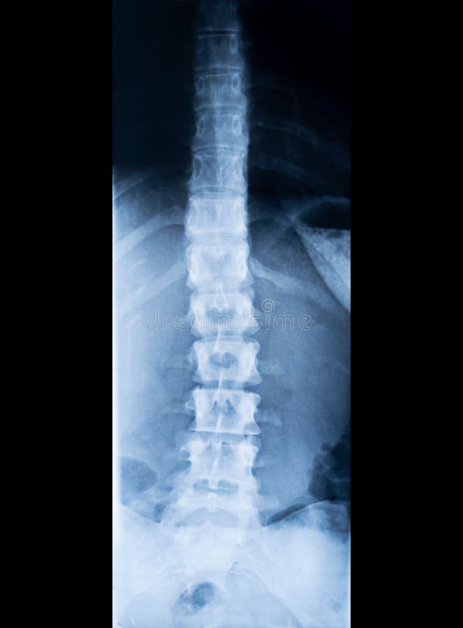 X-ray Of Human Spinal Column Stock Photo - Image of disc, patient ...