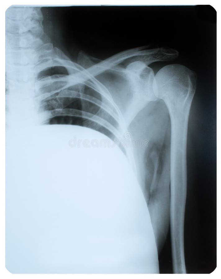 X-ray image. stock image. Image of shoulder, articulation - 27660889