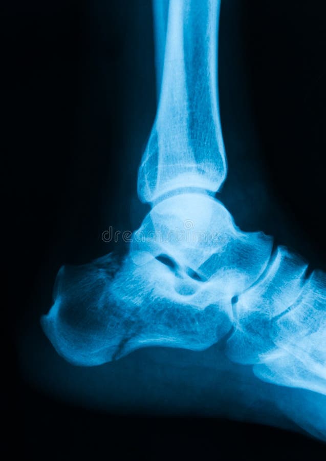 X-ray Image of Ankle, Lateral View. Stock Image - Image of scan ...