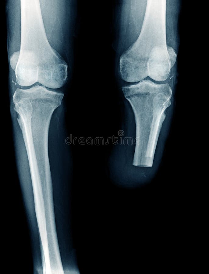 BKA x-ray image stock image. Image of knee, angiogram - 116817571