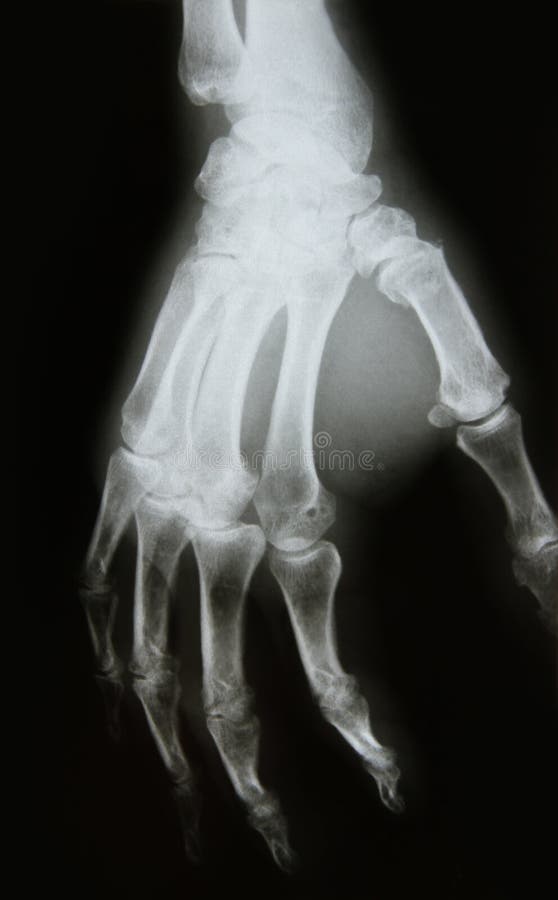 X-ray Image of the Bones of Arm Stock Image - Image of radiology ...