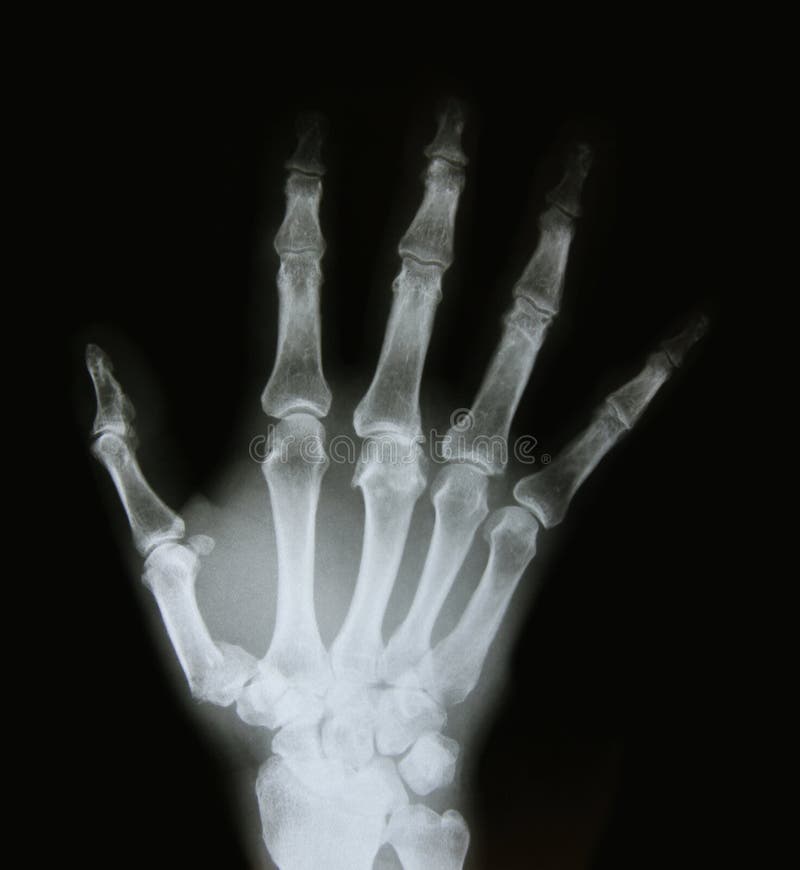 X-ray Image of the Bones of Arm Stock Photo - Image of check, link ...