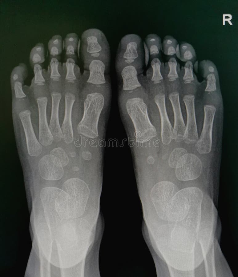 X-ray Image, Both Foot AP View, Show Normal Pediatric Bone. Stock Photo ...