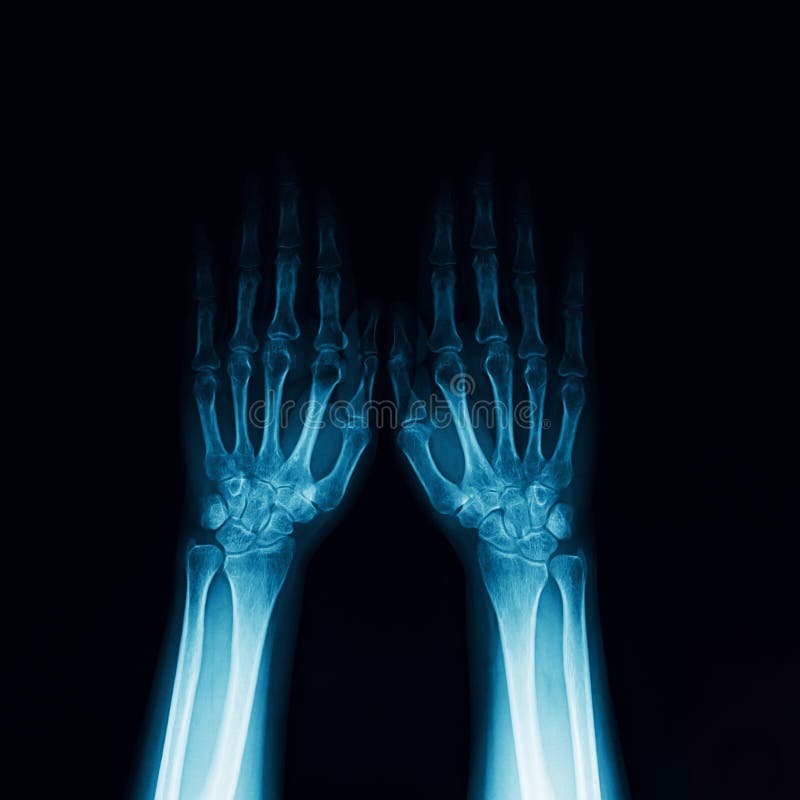 Black People Bone Density Stock Photos - Free & Royalty-Free Stock ...