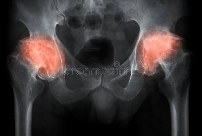 X-ray Image of Both Hip, AP View. Stock Image - Image of crest ...