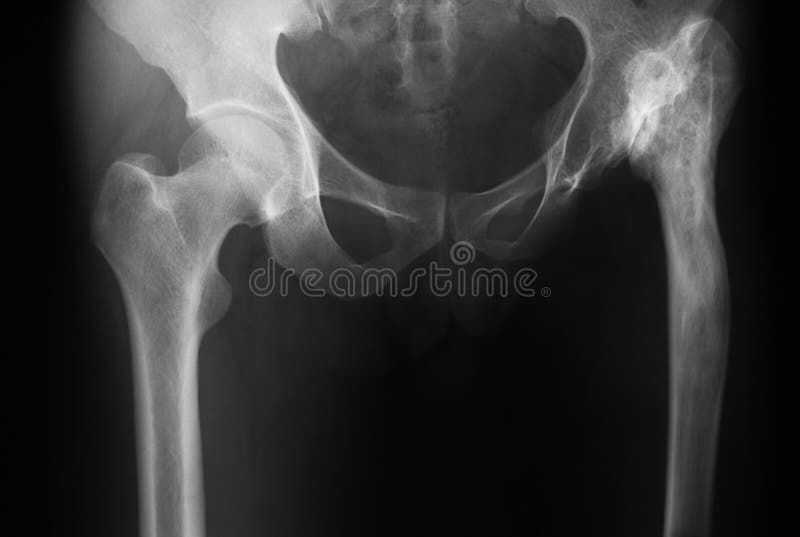X-ray Image of Pelvic and Hip, AP View. Stock Photo - Image of human ...